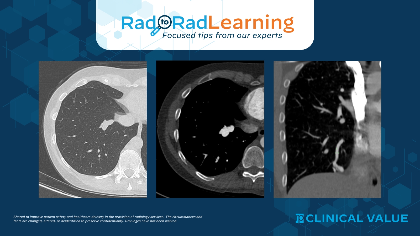 Rad to Rad Learning: Pulmonary AVM