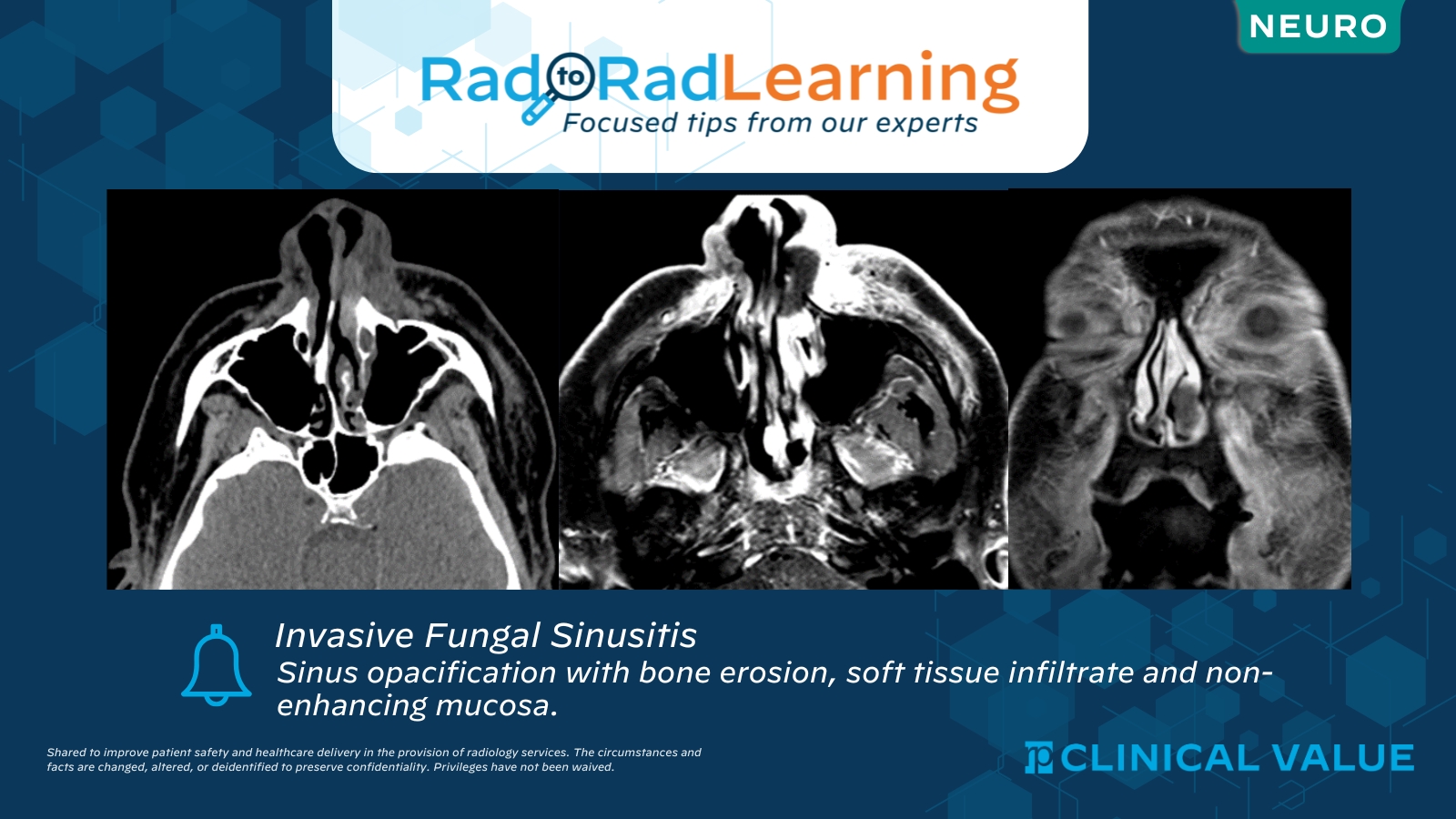 Rad to Rad Learning: Invasive Fungal Sinusitis