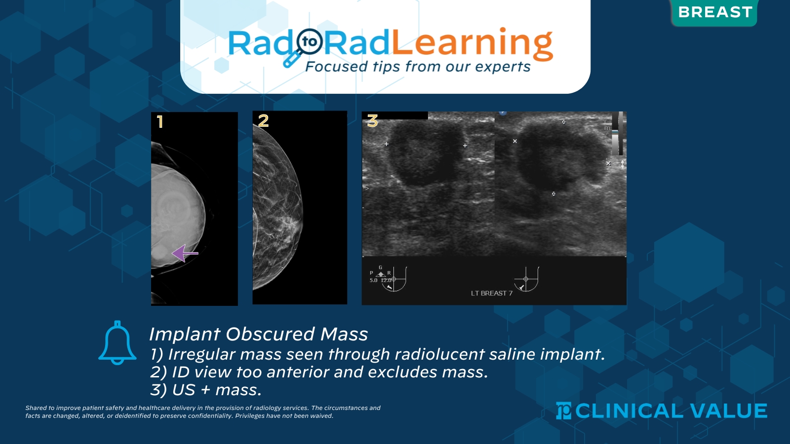 Rad to Rad Learning: Implant Obscured Mass