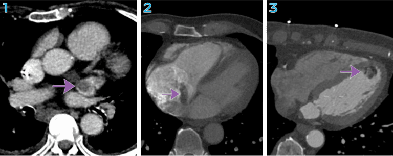 Rad to Rad Learning: Incidental Intra-Cardiac Lesions