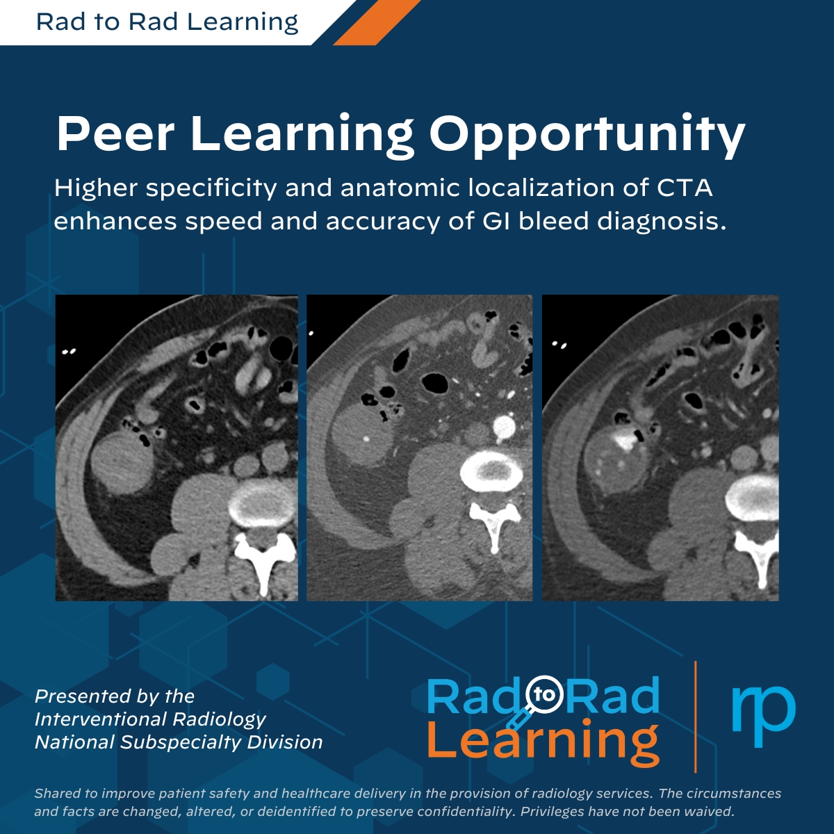 Rad to Rad Learning: Active GI Bleed on CTA