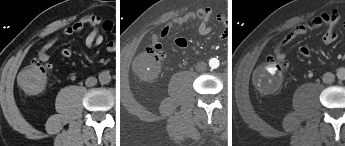 Rad To Rad Learning Active Gi Bleed On Cta