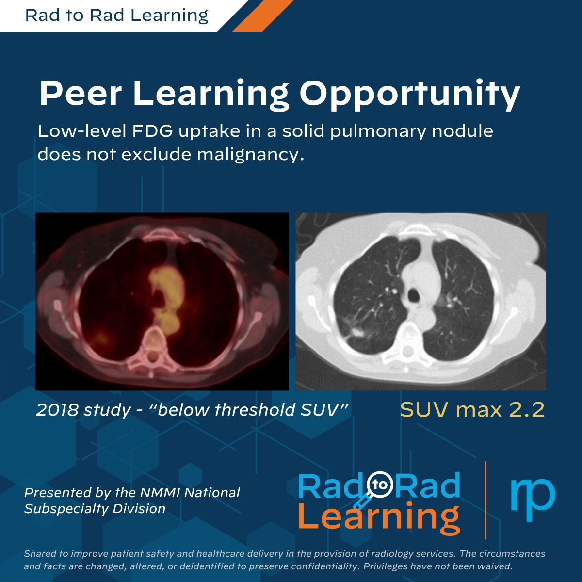 Rad to Rad Learning: Solid Pulmonary Nodules on FDG PET/CT