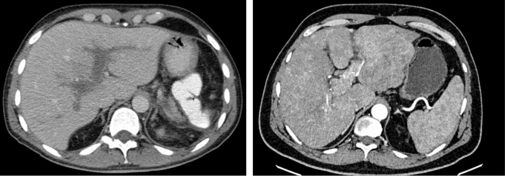Rad to Rad Learning: Portal Vein Thrombosis