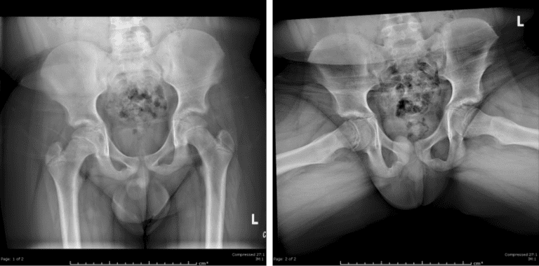 Rad to Rad Learning: Slipped Capital Femoral Epiphysis
